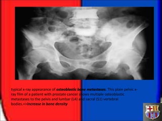 metastatic-bone-tumor.ppt