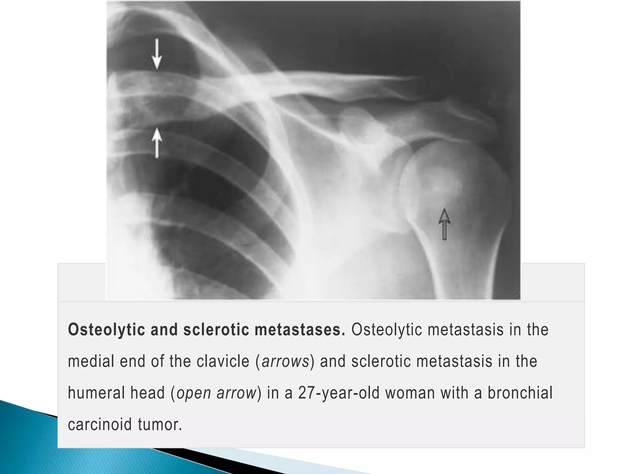Metastatic Bone Disease Ppt