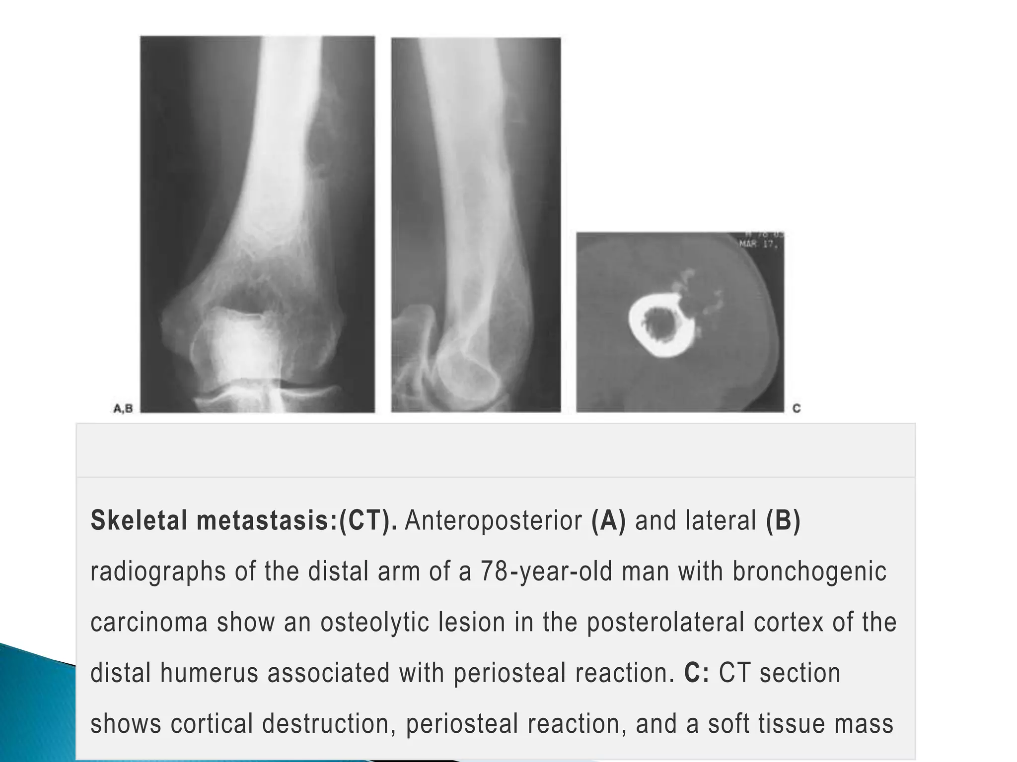 Metastatic bone disease | PPTX