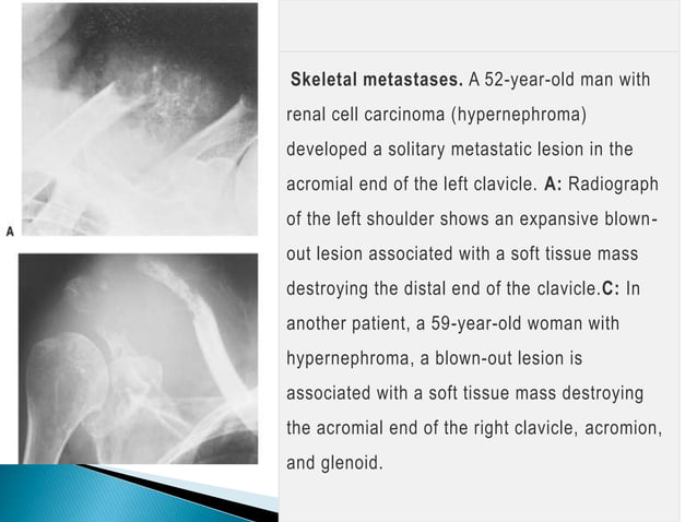 Metastatic bone disease | PPTX