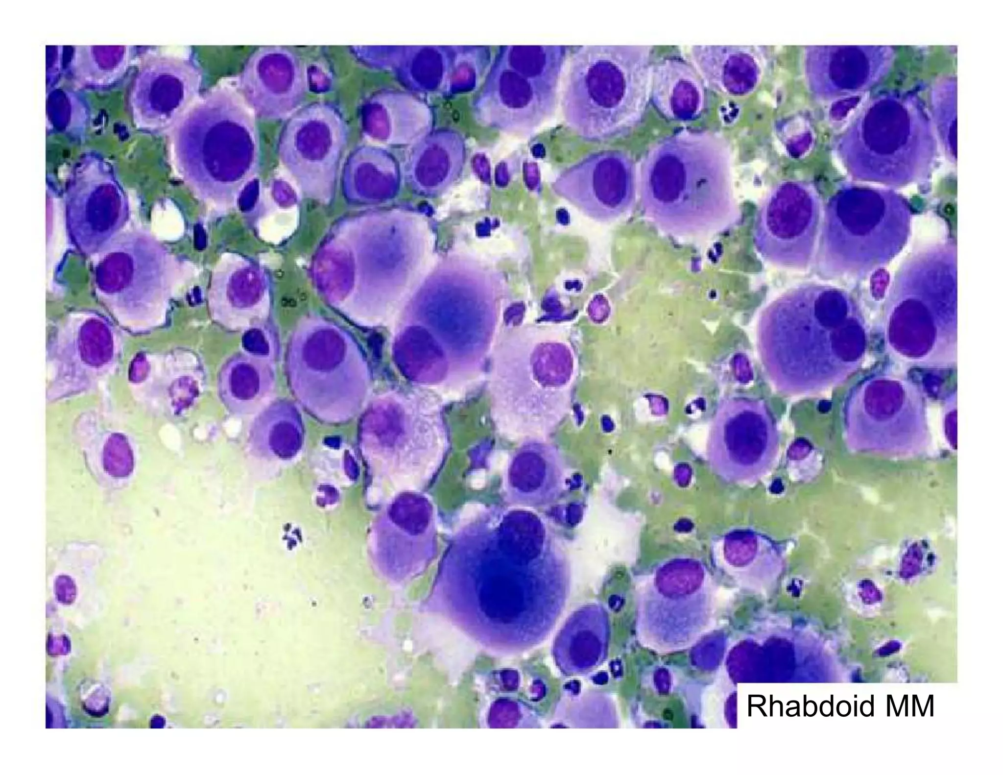 FNA cytology of metastatic malignancies | PPT