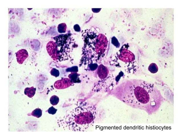 Fna Cytology Of Metastatic Malignancies Ppt