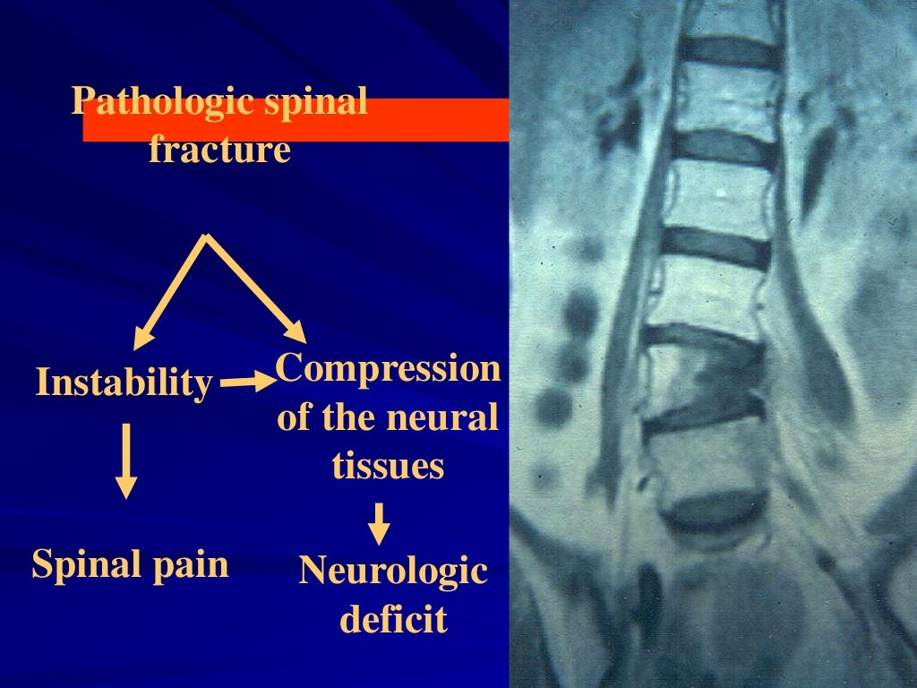 Metastatic Tumors of the Spinal Column