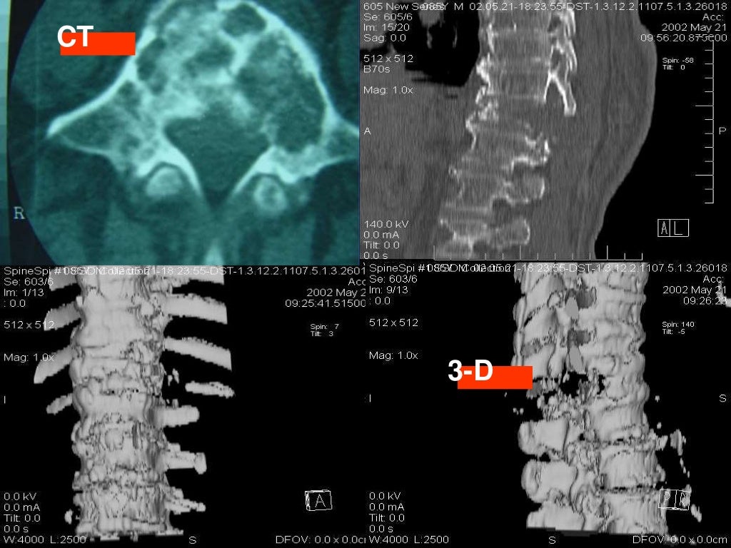 Metastatic Tumors of the Spinal Column
