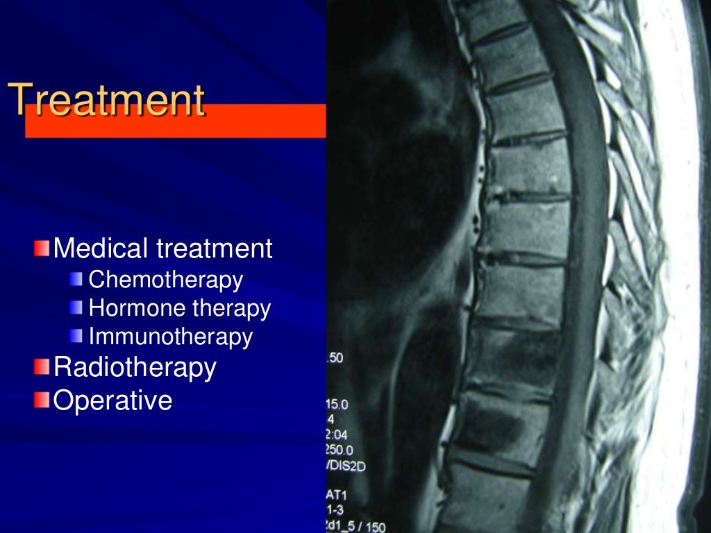 Metastatic Tumors of the Spinal Column
