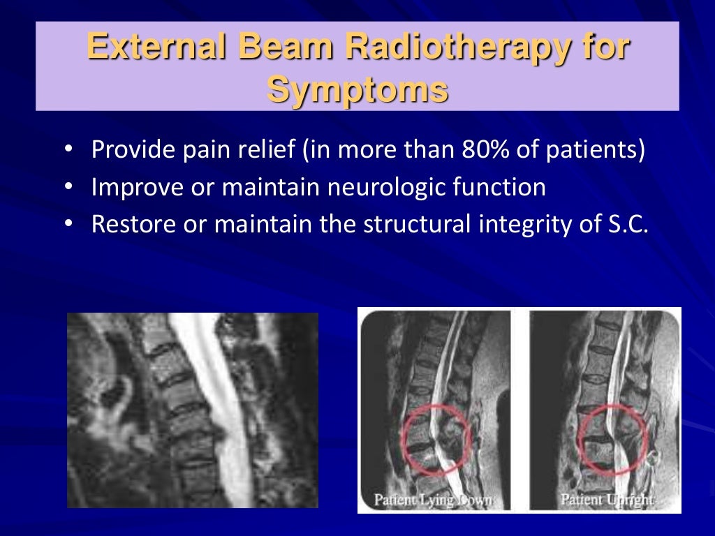 Metastatic Tumors of the Spinal Column