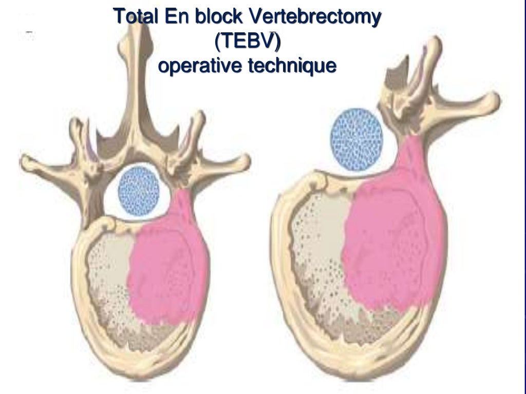 Metastatic Tumors of the Spinal Column