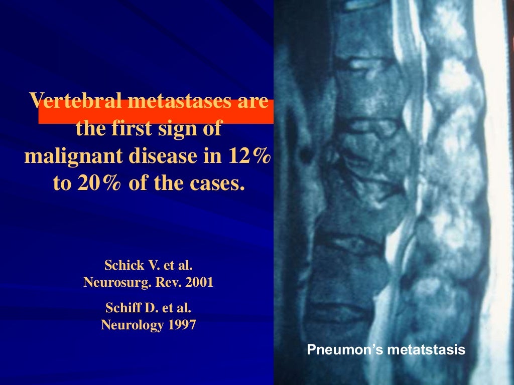 Metastatic Tumors of the Spinal Column