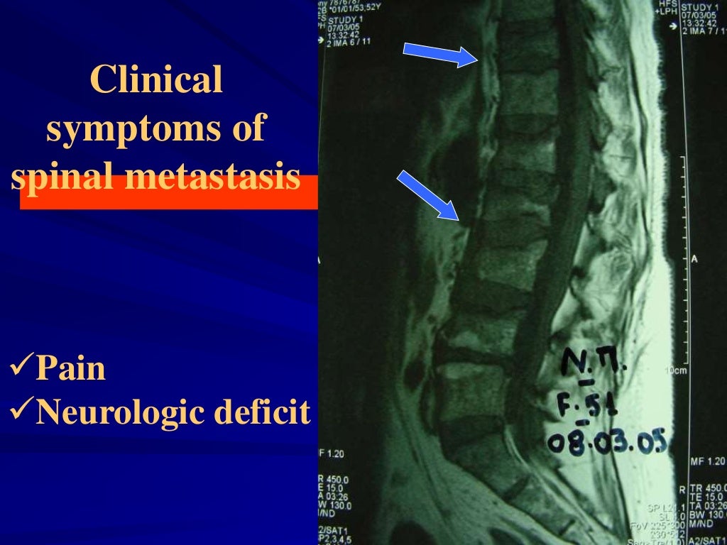 Metastatic Tumors of the Spinal Column