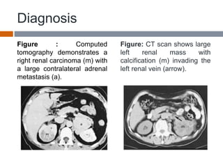Metastatic renal cell carcinoma | PPT