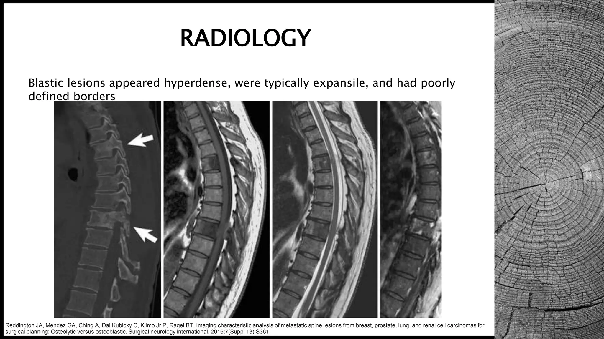 Metastatic Spine Lesions | PPT