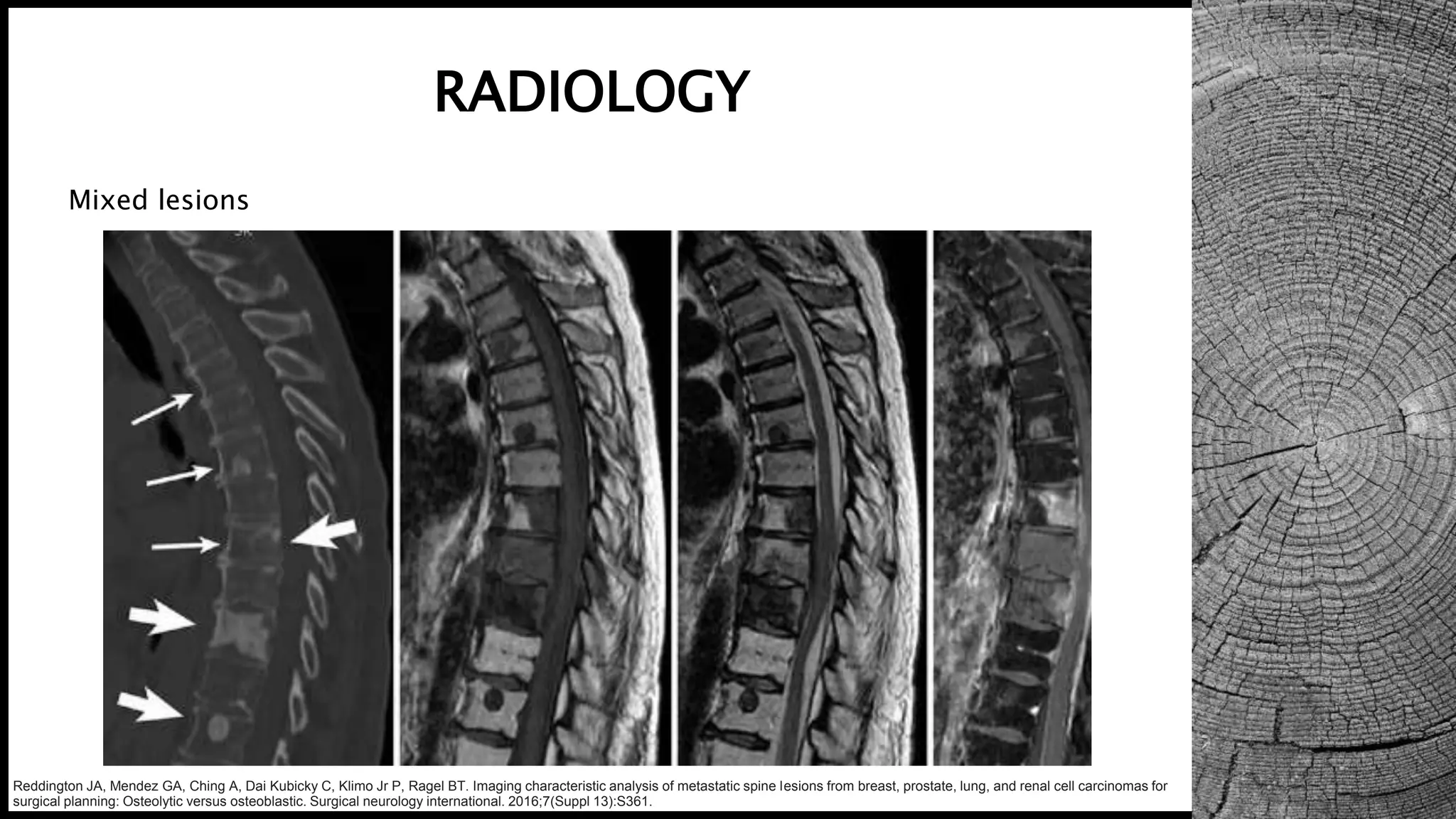 Metastatic Spine Lesions | PPT