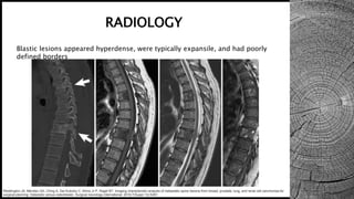 Metastatic Spine Lesions | PPTX