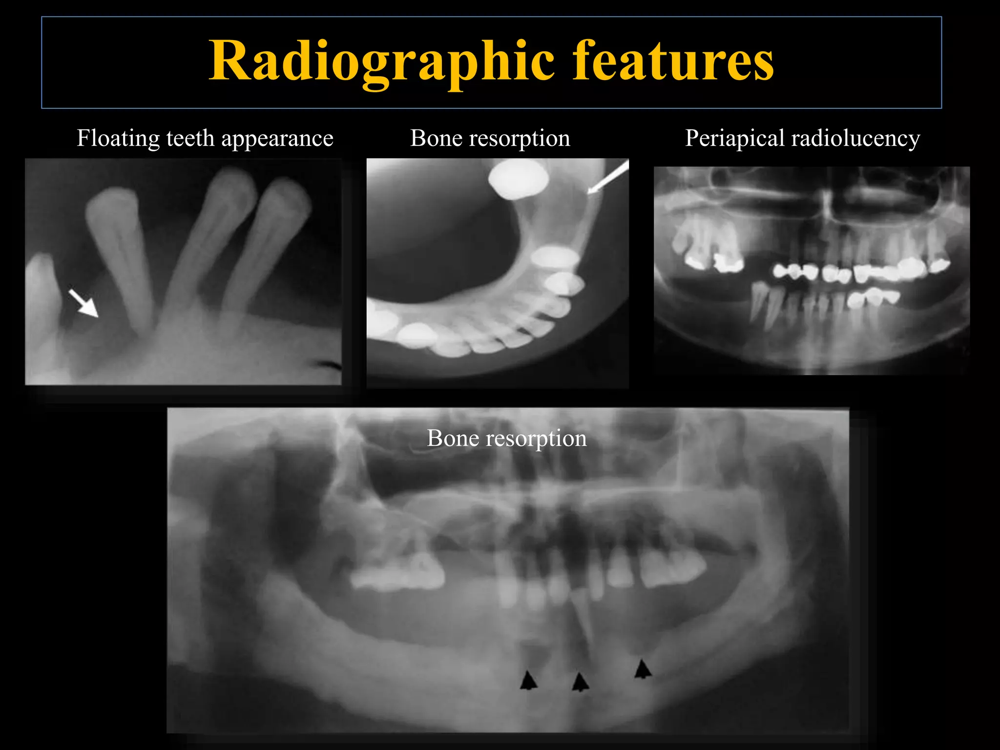 Metastatic tumors of jaws | PPTX