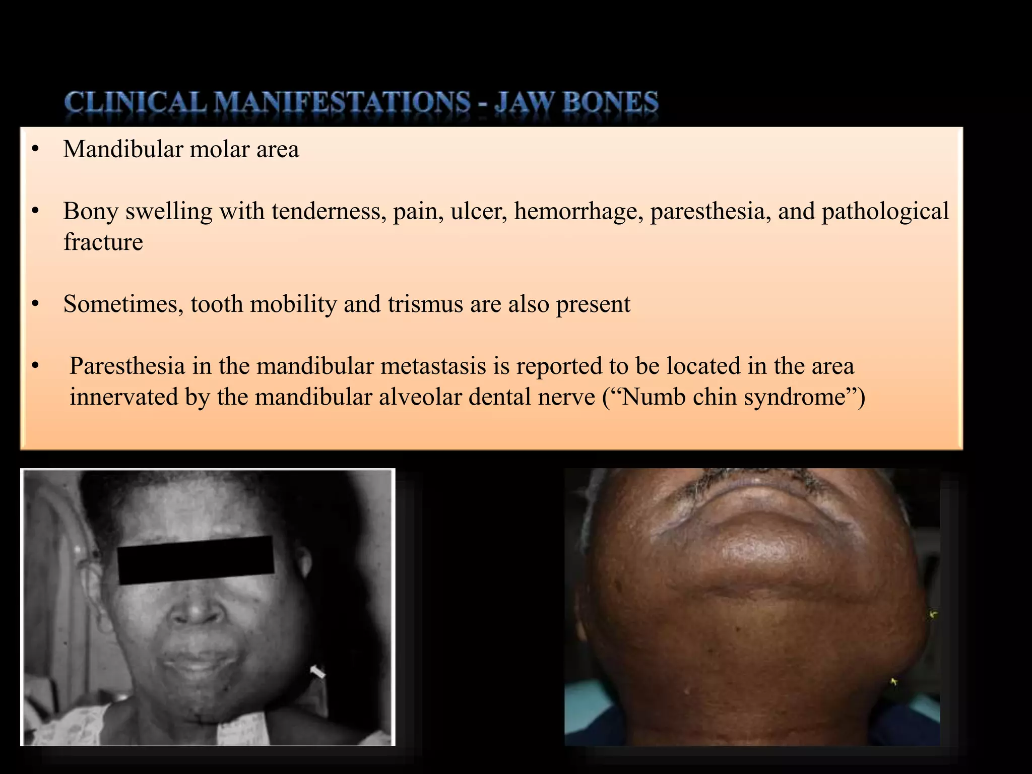 Metastatic tumors of jaws | PPTX