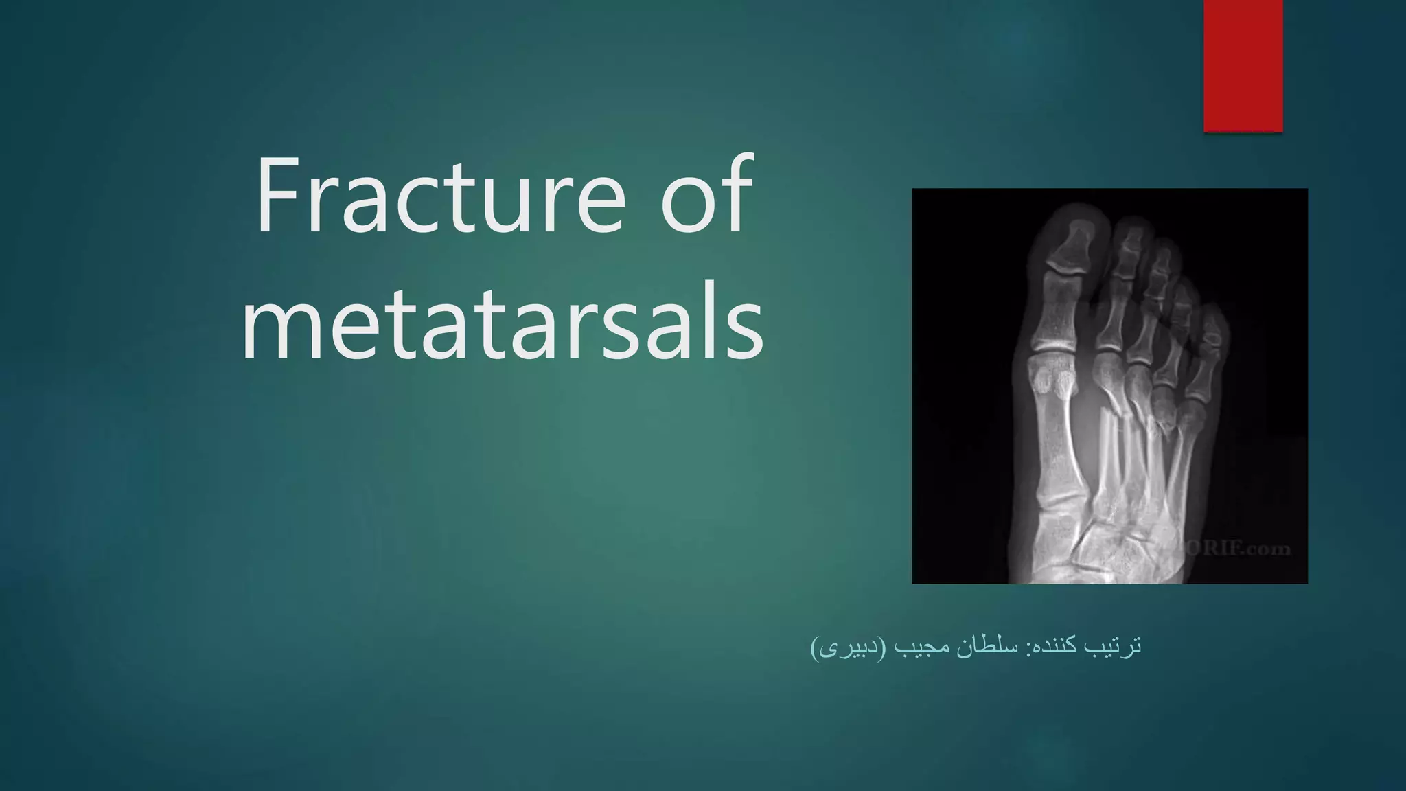 Metatarsal Fracture | PPT