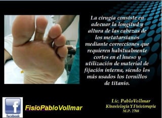 metatarsalgia fisioterapia pablo vollmar.PDF