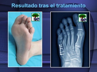 Metatarsalgia por deformidad congénita | PPT