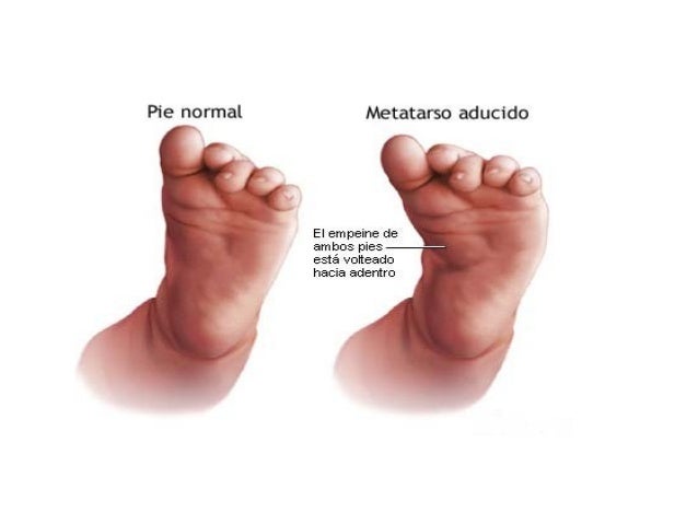 Metatarso varo