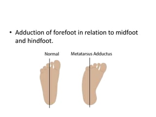 Metatarsus adductus | PPTX