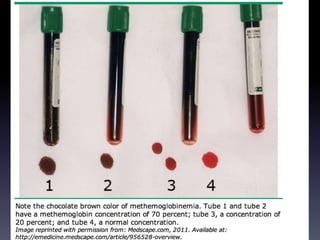 Methaemoglobinaemia a case study | PPT