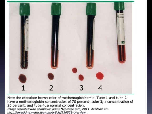 Methaemoglobinaemia a case study
