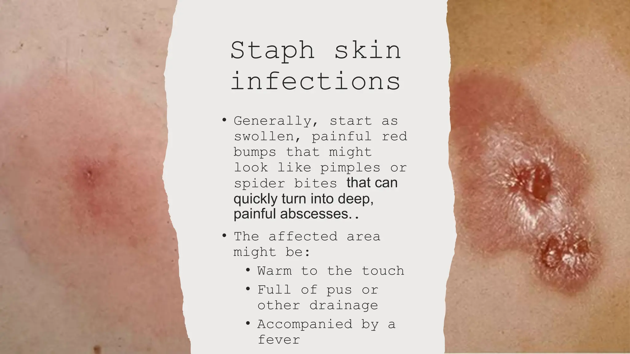 Methicillin-resistant Staphylococcus Aureus (MRSA) | PPTX