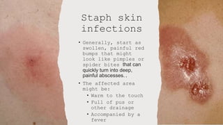 Methicillin-resistant Staphylococcus Aureus (MRSA) | PPTX