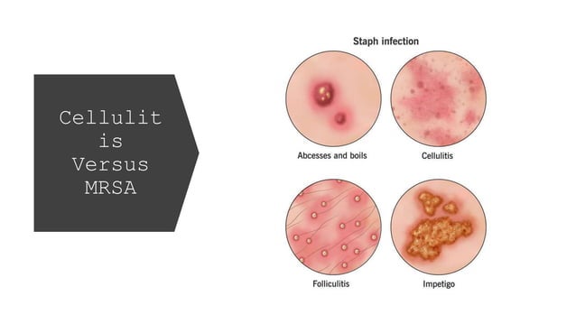 Methicillin-resistant Staphylococcus Aureus (MRSA) | PPTX
