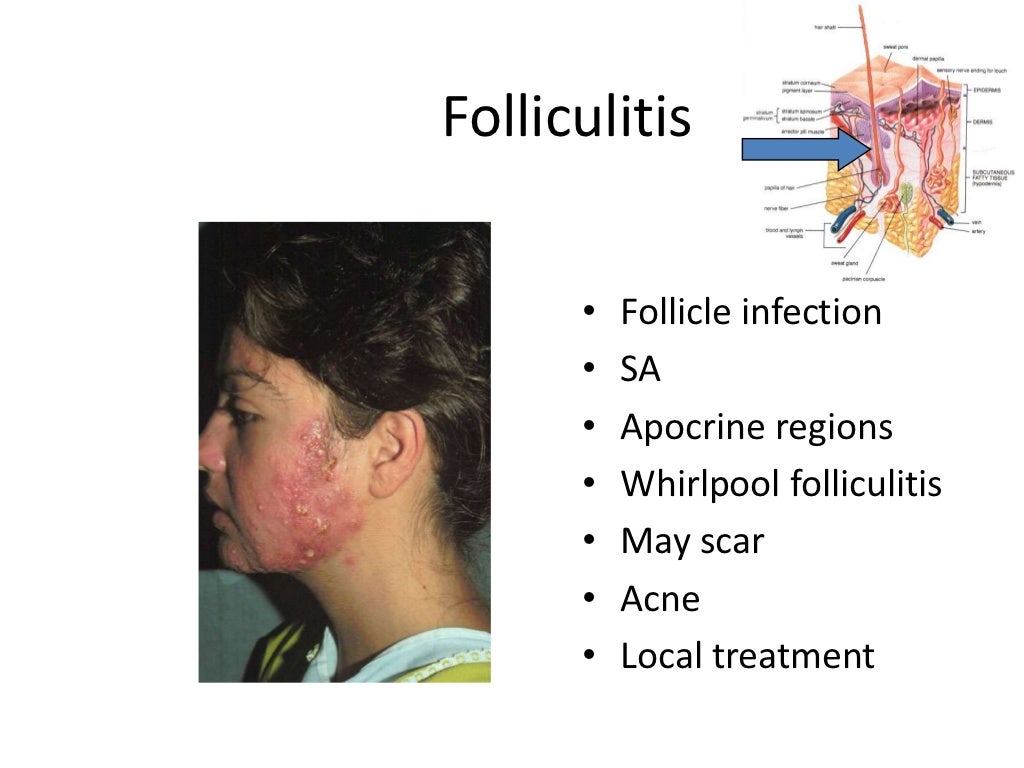 Methicillin resistant staphylococcus aureus