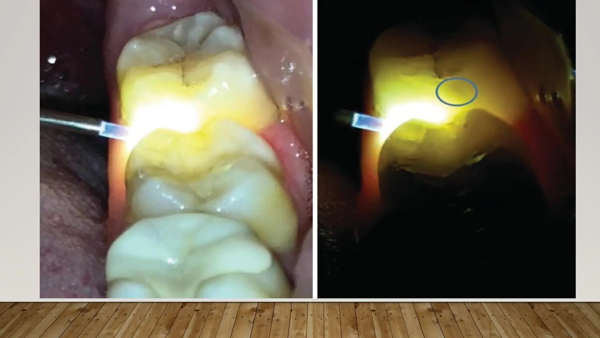 method of caries diagnosis. In dentistry pptx | PPTX