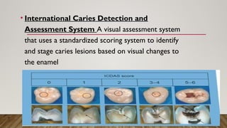 method of caries diagnosis. In dentistry pptx | PPTX