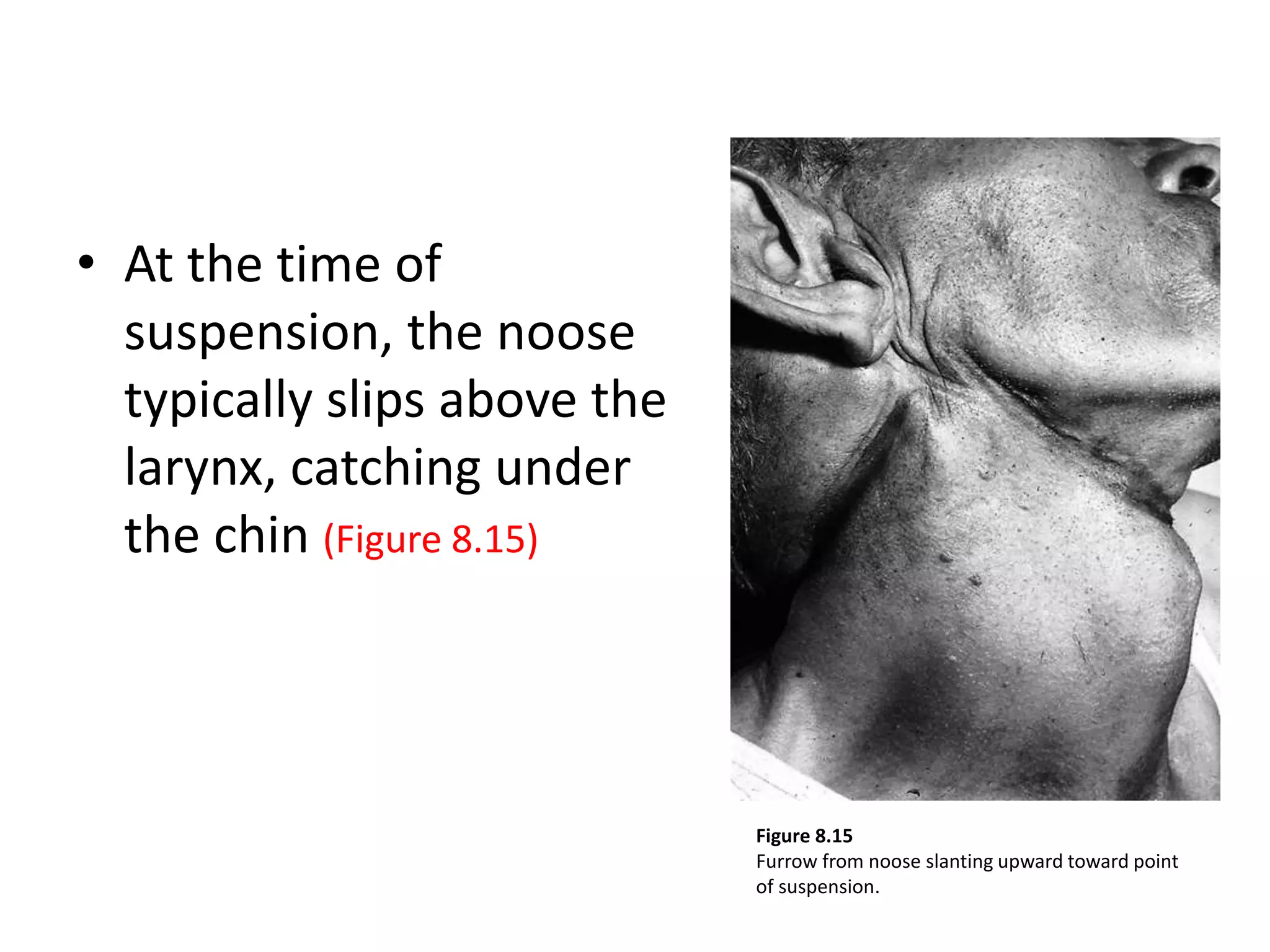 Strangulation (Hanging) | PPTX