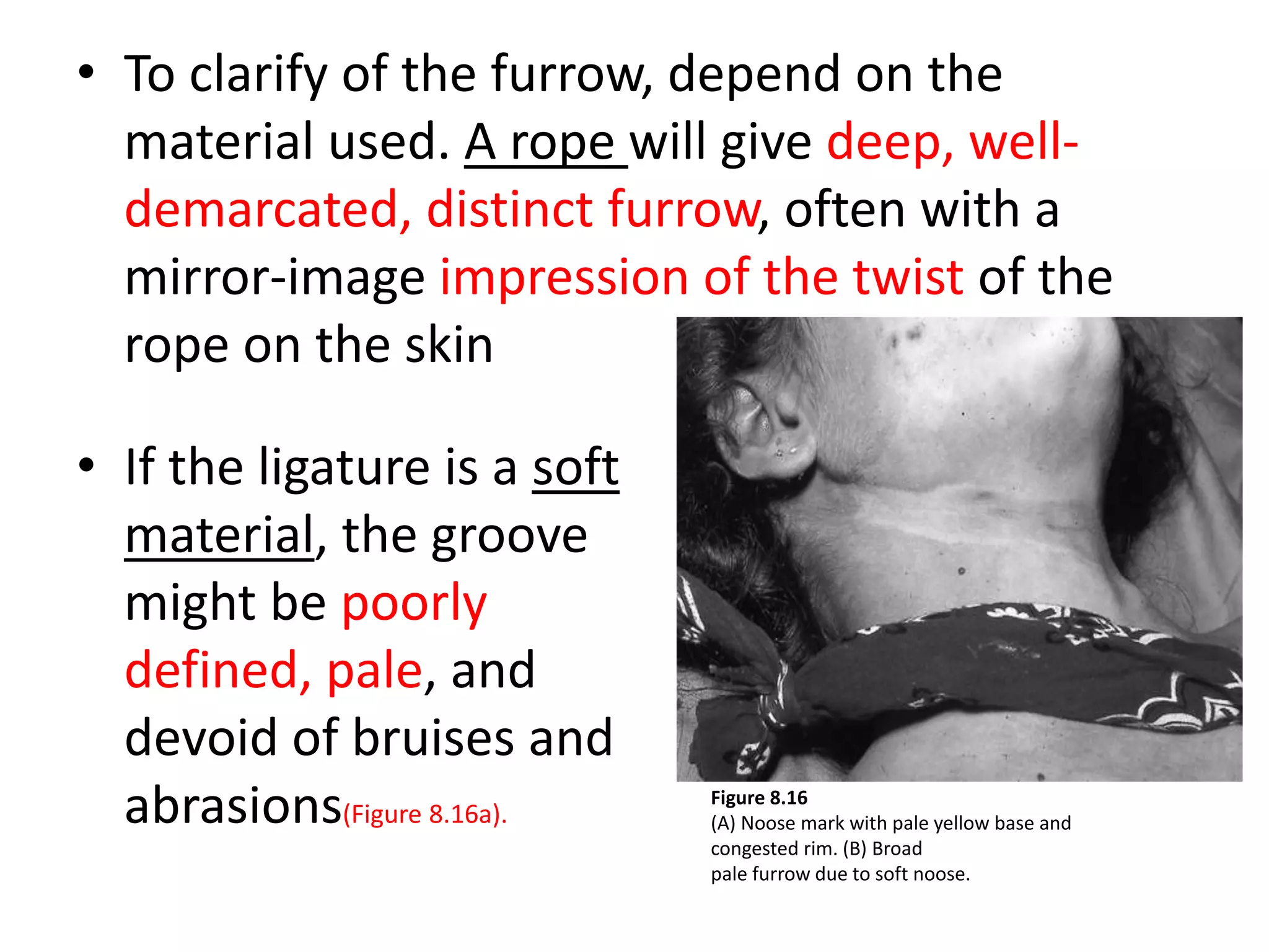 Strangulation (Hanging) | PPTX