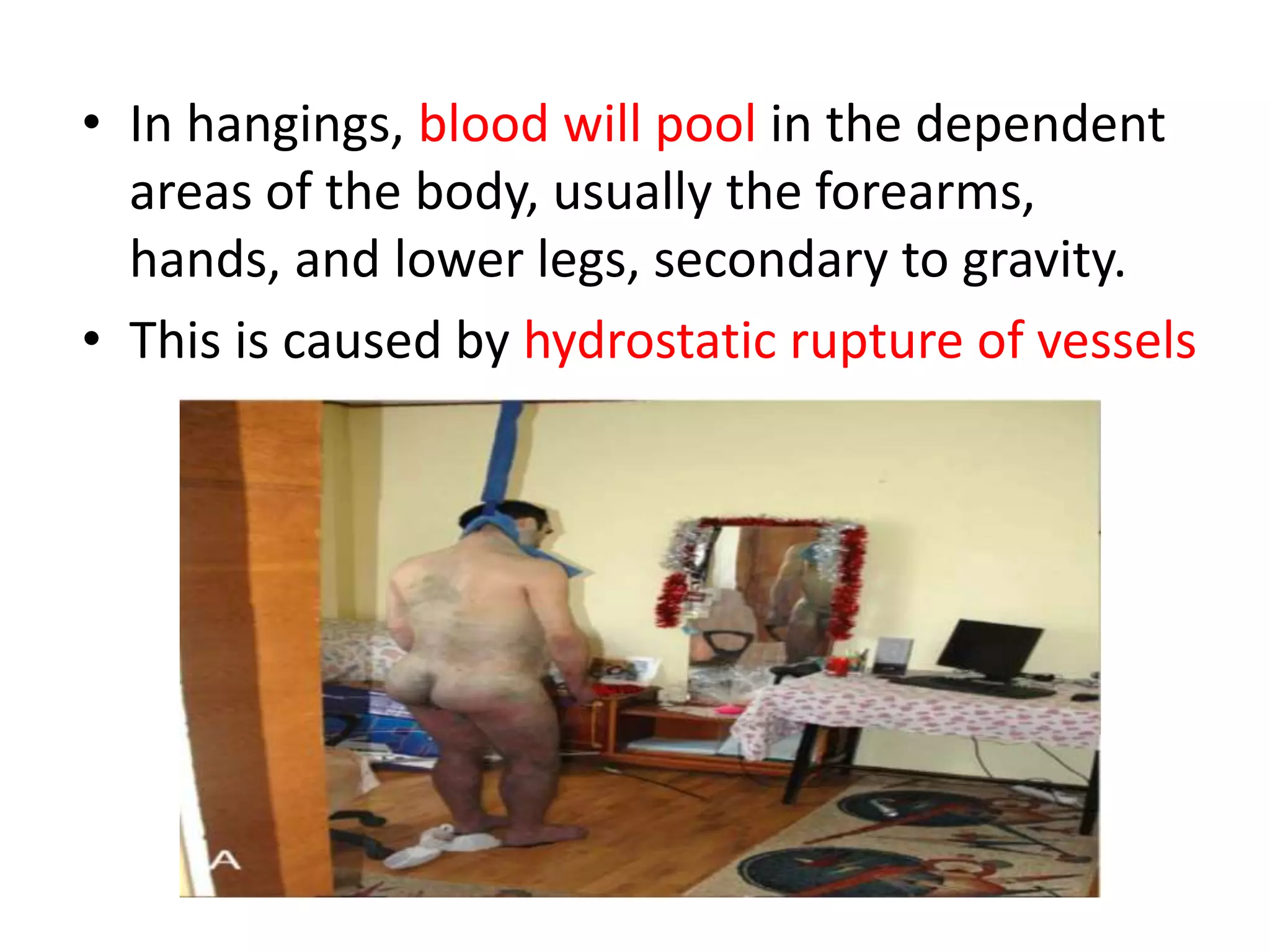 Strangulation (Hanging) | PPTX