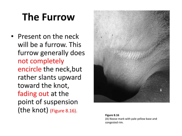 Strangulation (Hanging) | PPTX