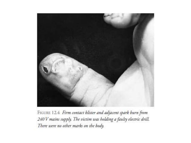 Strangulation (Hanging) | PPTX