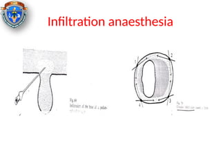 Methods of Anaesthesia Methods of Anaesthesia.pptx