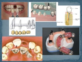 Methods of classifying fixed bridge | PPTX