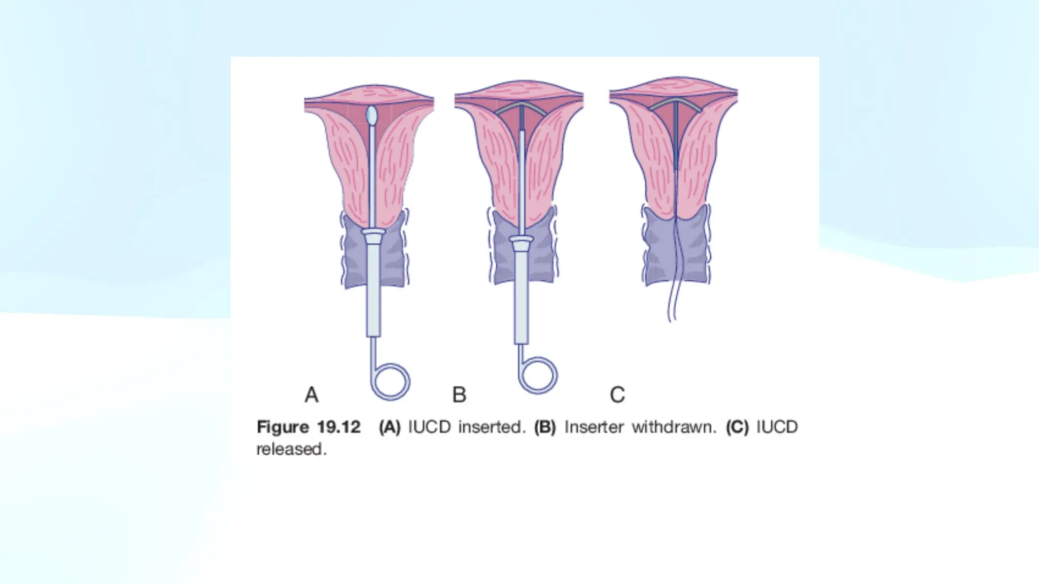 Methods of contraception OBG GYN 2nd year.pptx
