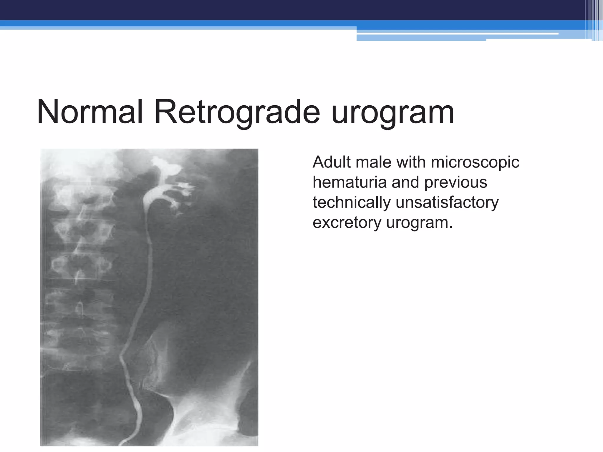 Methods of imaging of the urinary tract using contrast | PPTX