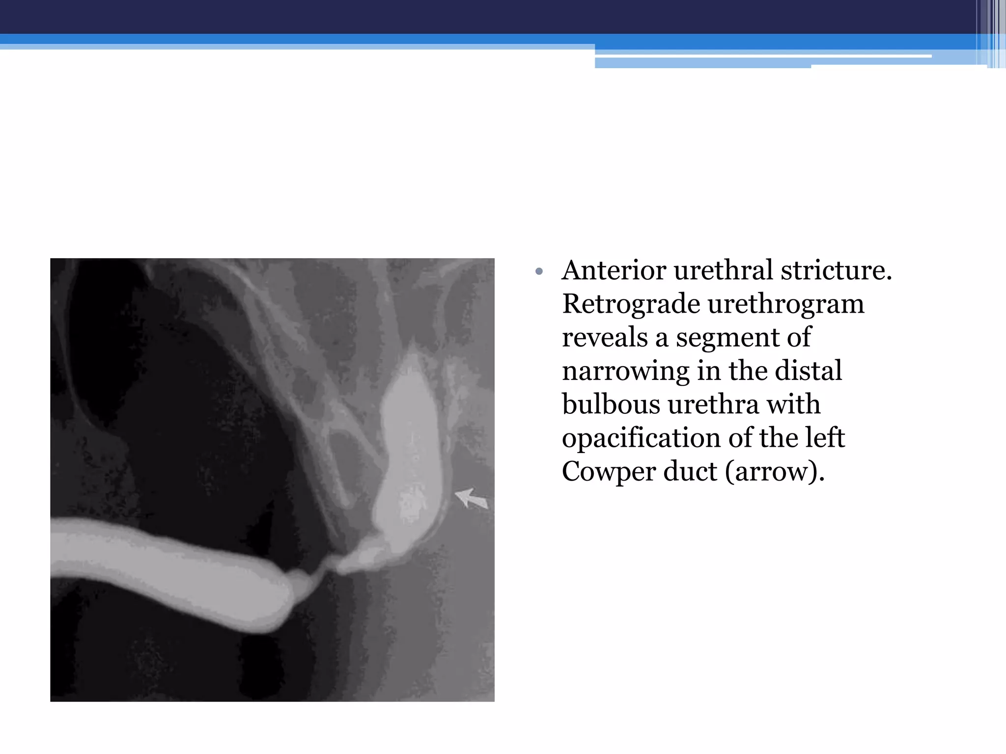 Methods of imaging of the urinary tract using contrast | PPTX