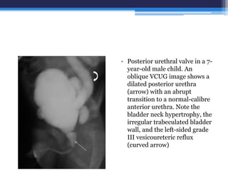 Methods of imaging of the urinary tract using contrast | PPTX