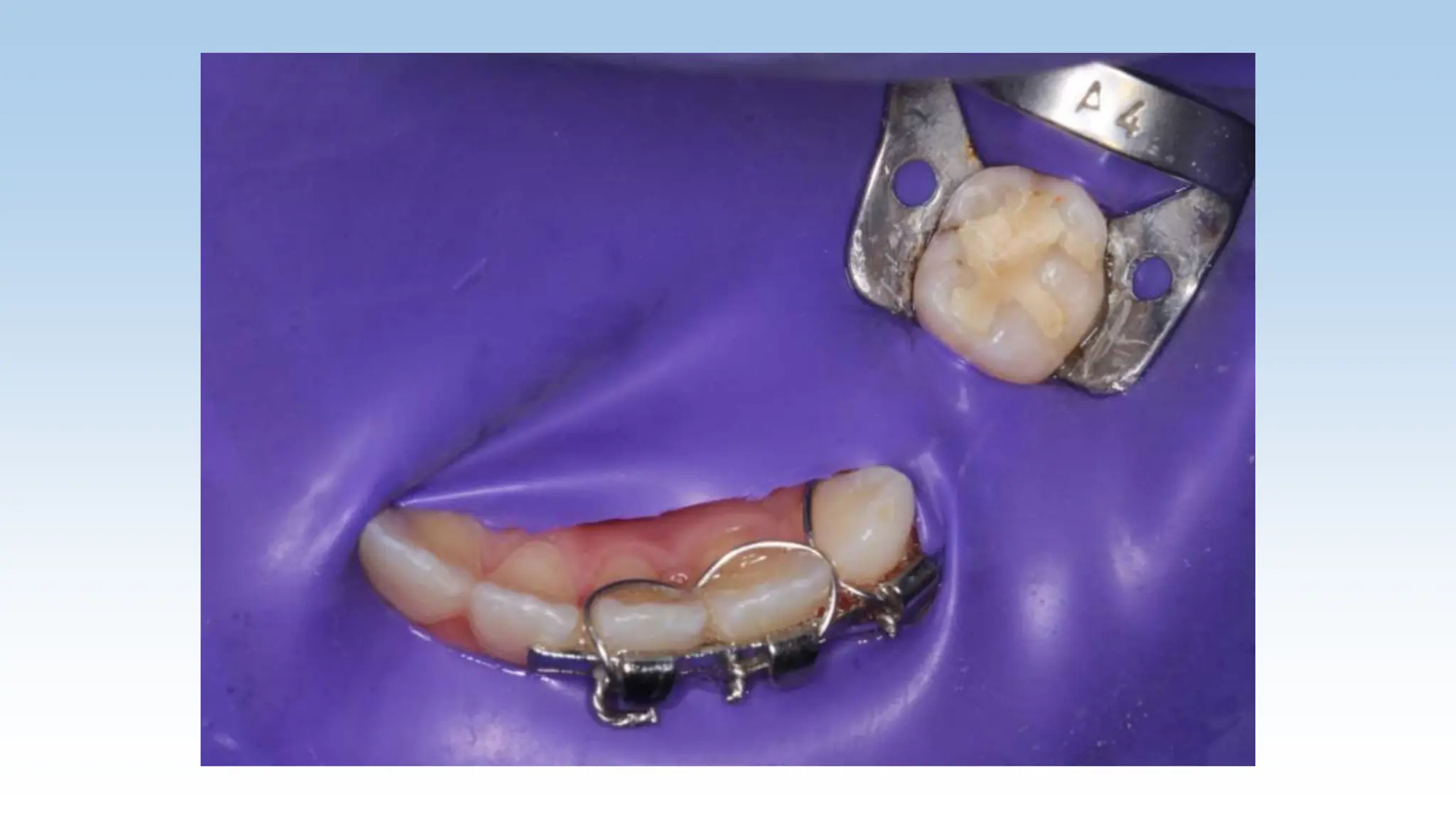 methods of isolation and rubber dam.pptx