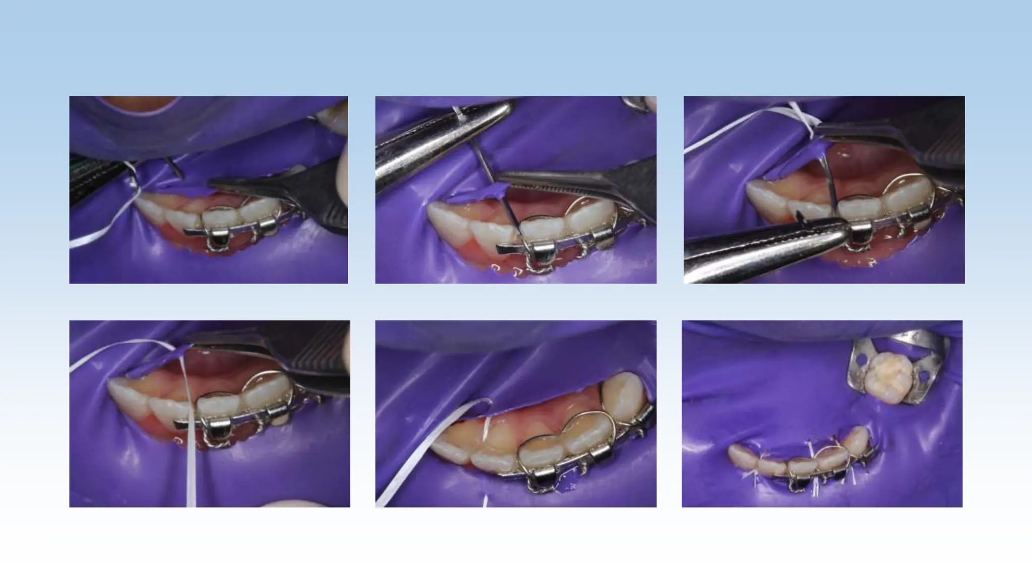 methods of isolation and rubber dam.pptx