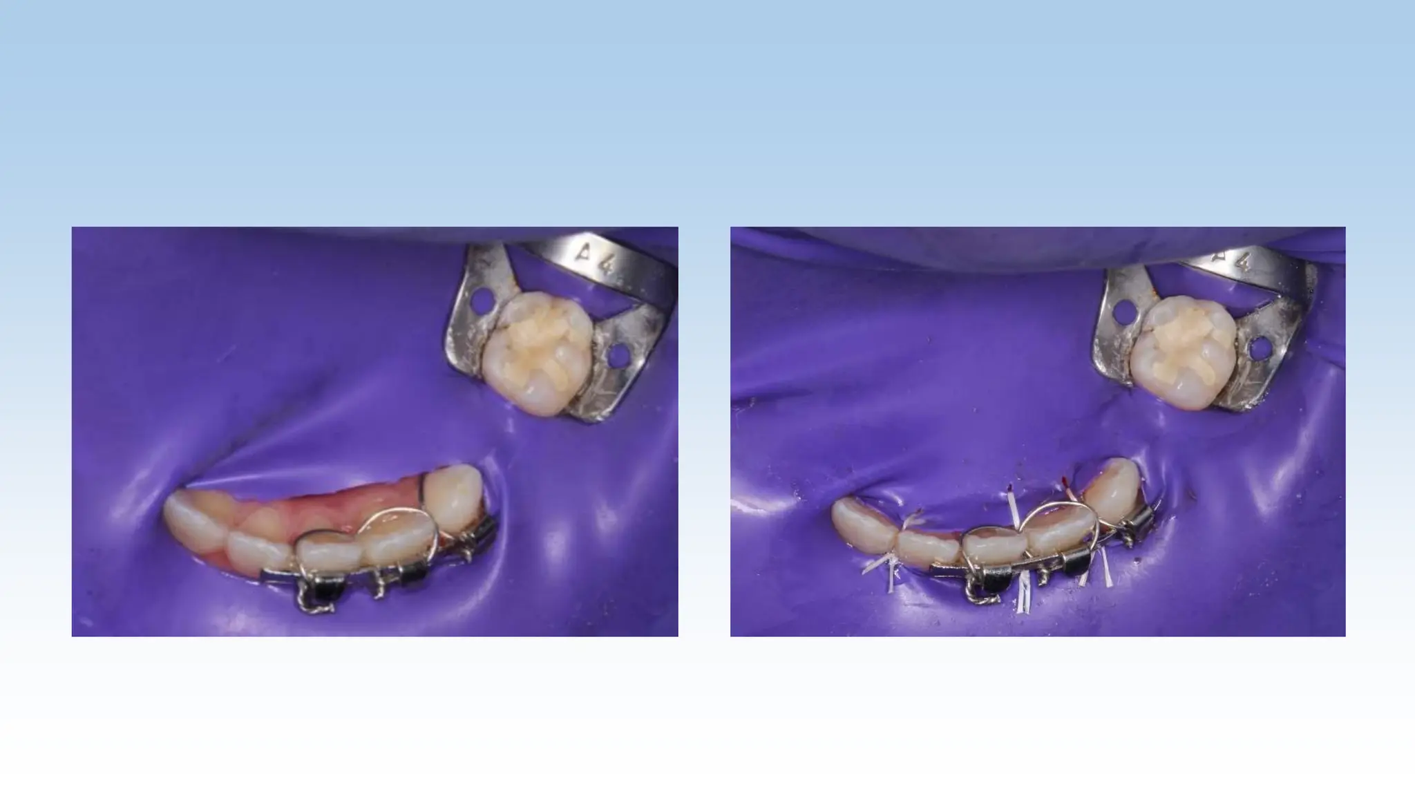 methods of isolation and rubber dam.pptx