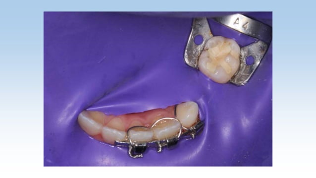 methods of isolation and rubber dam.pptx