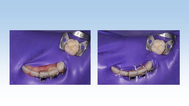 methods of isolation and rubber dam.pptx