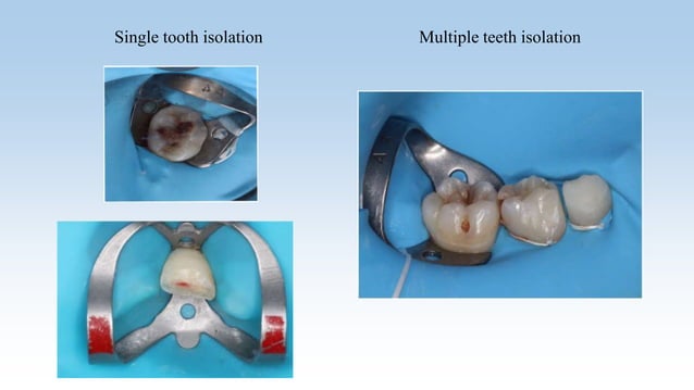 methods of isolation and rubber dam.pptx