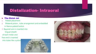 Methods of space gaining ortho | PPTX